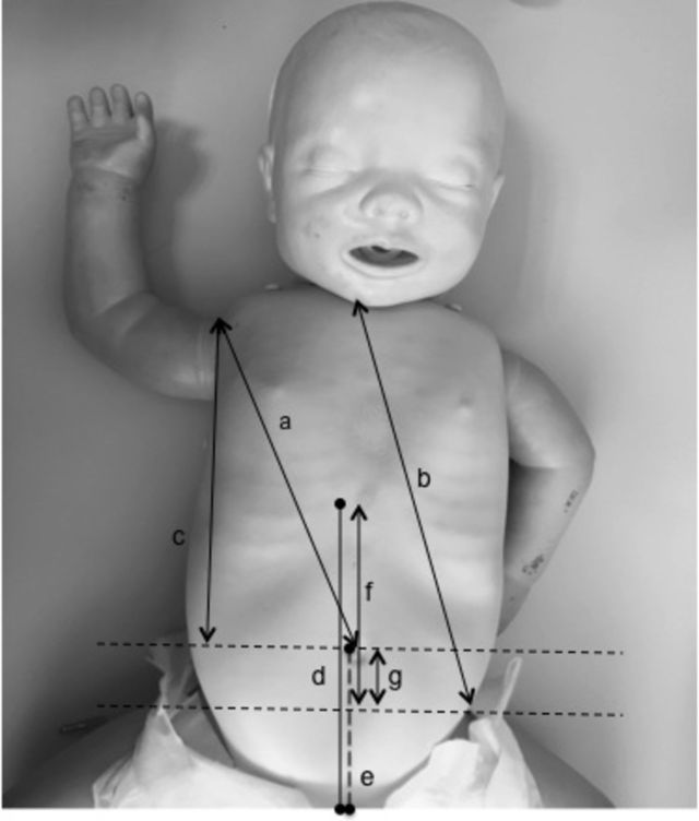 Placement of umbilical catheters | Neonatal Research